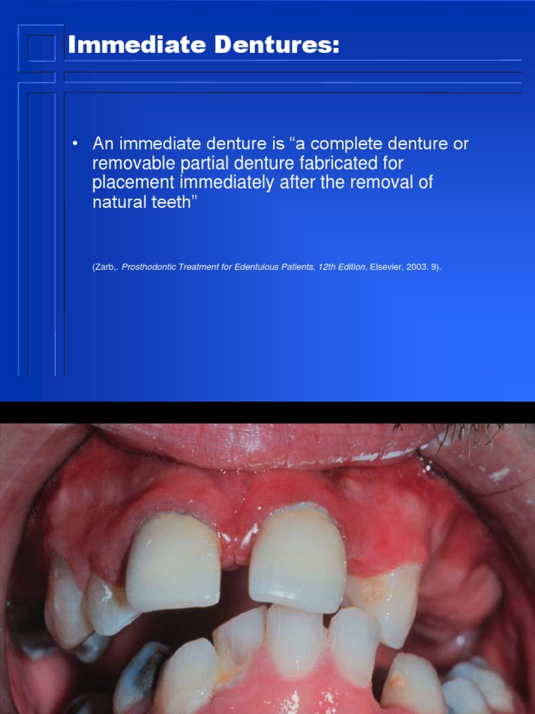 Immediate Denture | PDF | Dentures | Dentistry