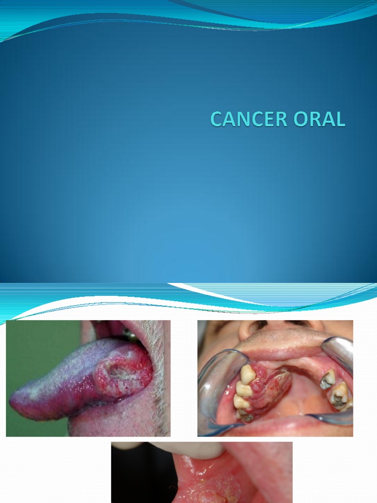 Carcinoma Oral Diagnóstico Y Síntomas Pdf Cáncer Neoplasias