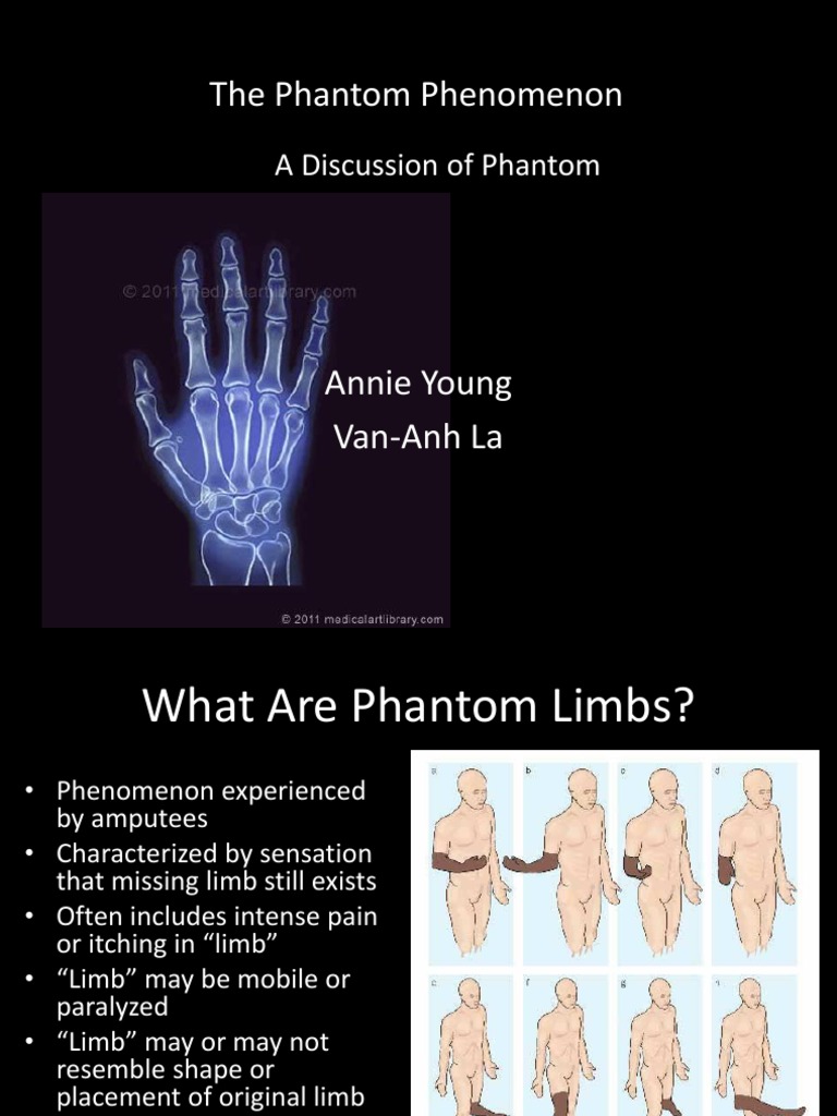 A Discussion of Phantom Limbs | PDF | Neuroplasticity | Experimental ...