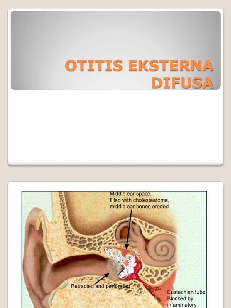 Otitis Eksterna Difusa | PDF