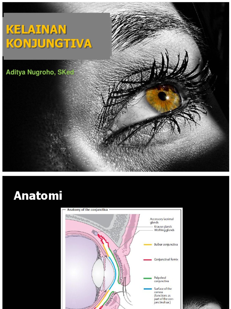 Konjungtiva Concretion | PDF