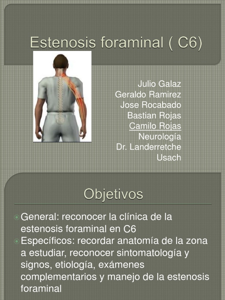 Estenosis Foraminal c6 | PDF | Dolor | Neurología