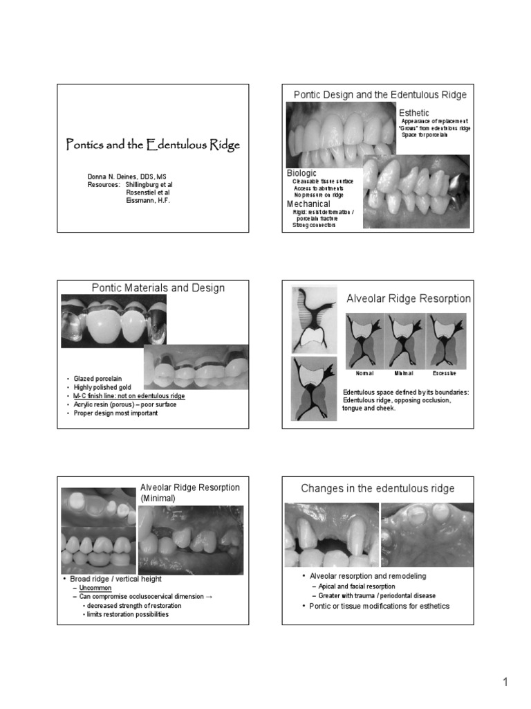 2 Pontics and The Edentulous Ridge | PDF | Mouth | Dentistry