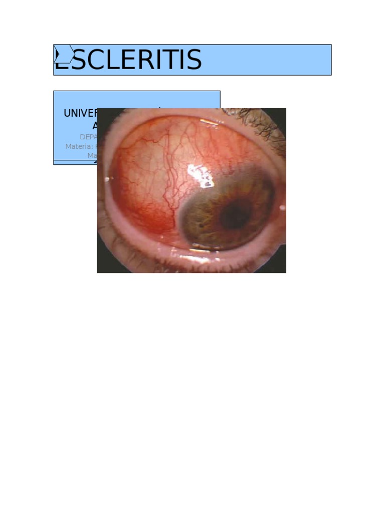 ESCLERITIS | Ojo humano | Droga anti-inflamatoria libre de esteroides ...
