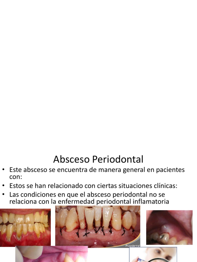 Tratamiento y Clasificación del Absceso Periodontal | PDF | Inflamación ...