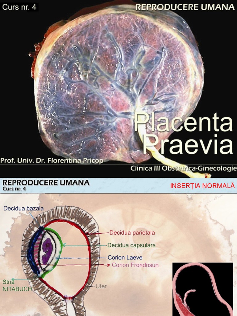 Placenta Praevia | PDF