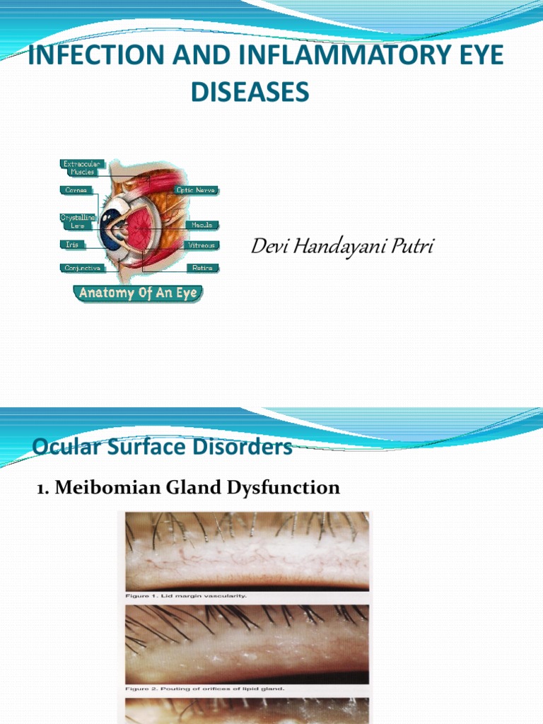 Infection and Inflammatory Eye Diseases | Ophthalmology | Diseases And ...