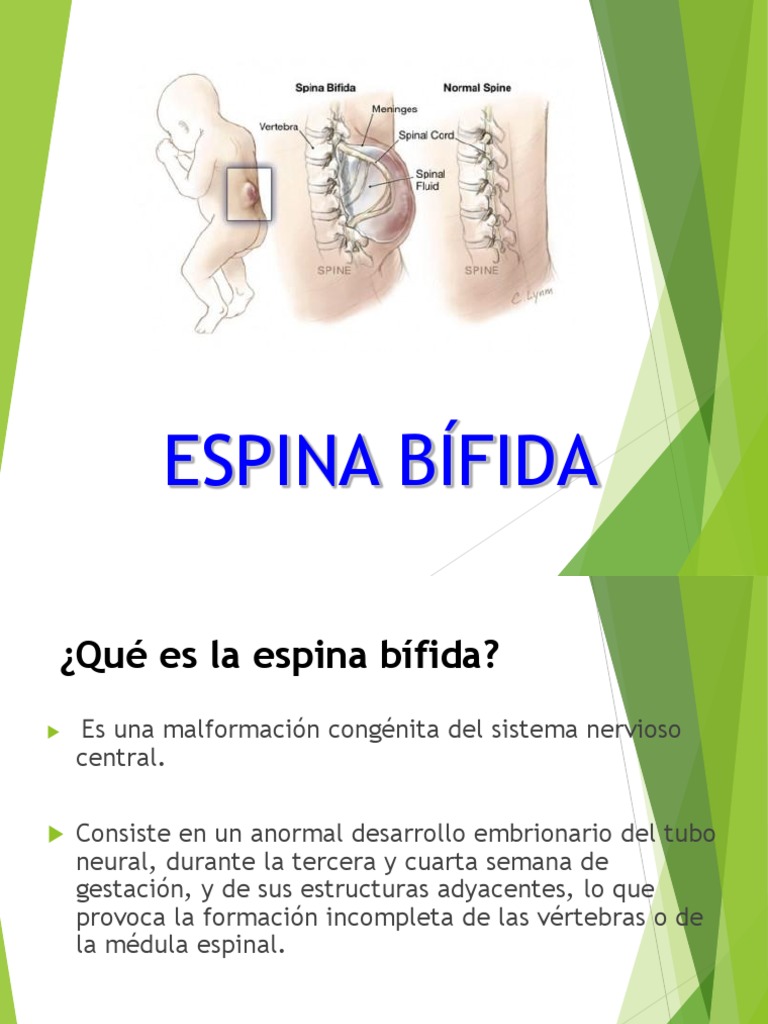 Espina Bifida Presentacion2 | Rtt | Ciencias de la Salud
