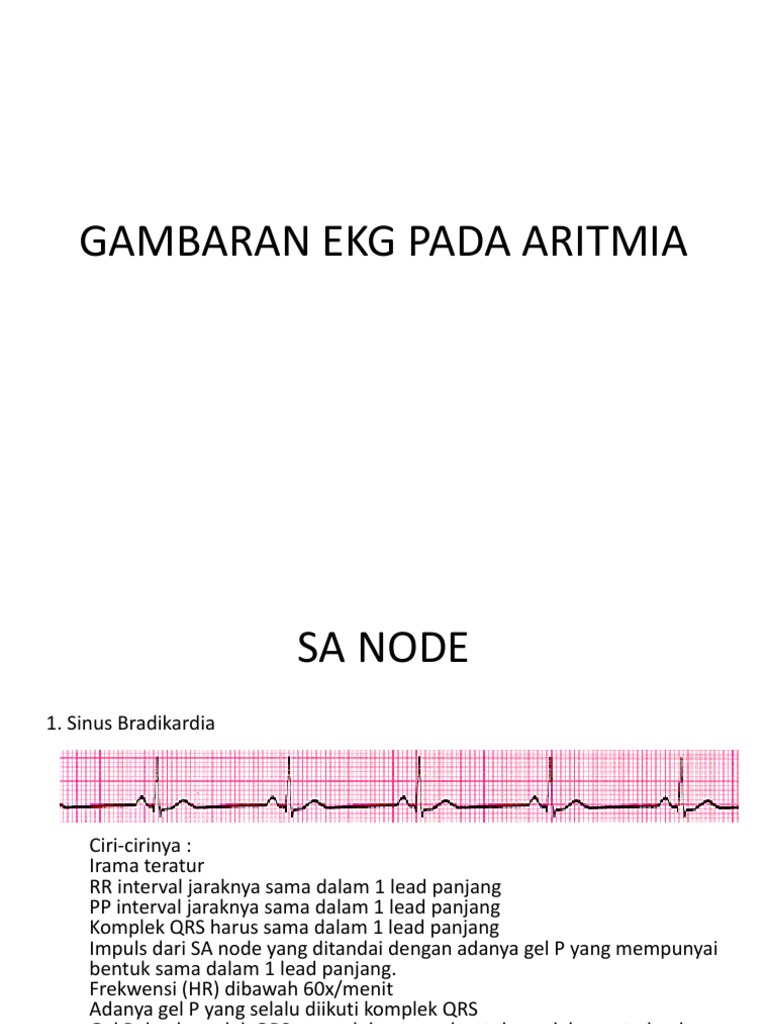 Gambaran Ekg Aritmia | PDF