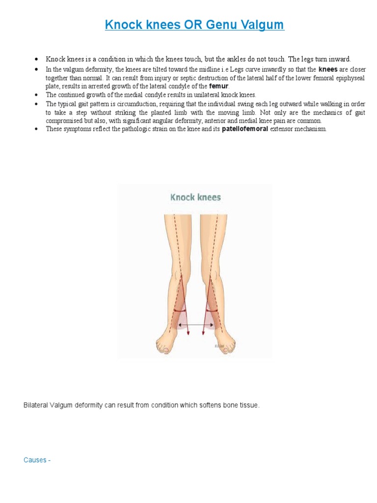 Genu Valgum | Knee | Dance Science