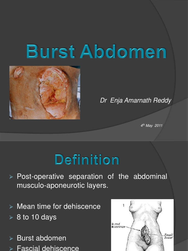 0347burst Abdomen | PDF | Surgery | Wound