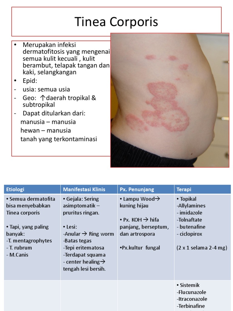 Tinea Corporis | PDF