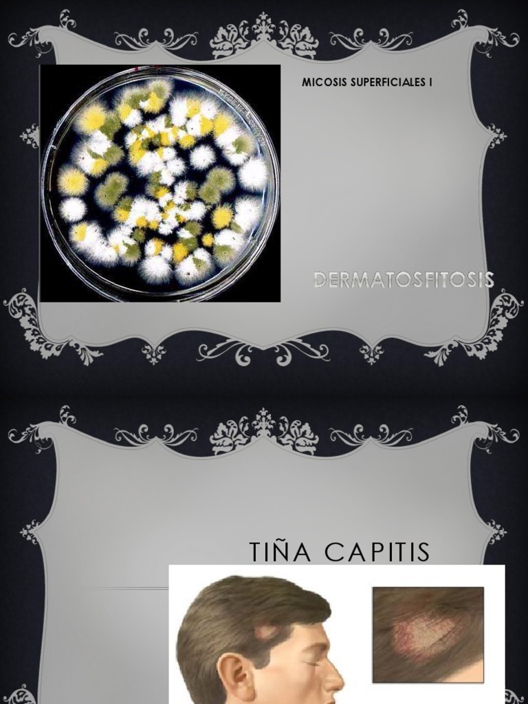 Tiña Capitis | PDF | Condiciones cutáneas | Dermatología