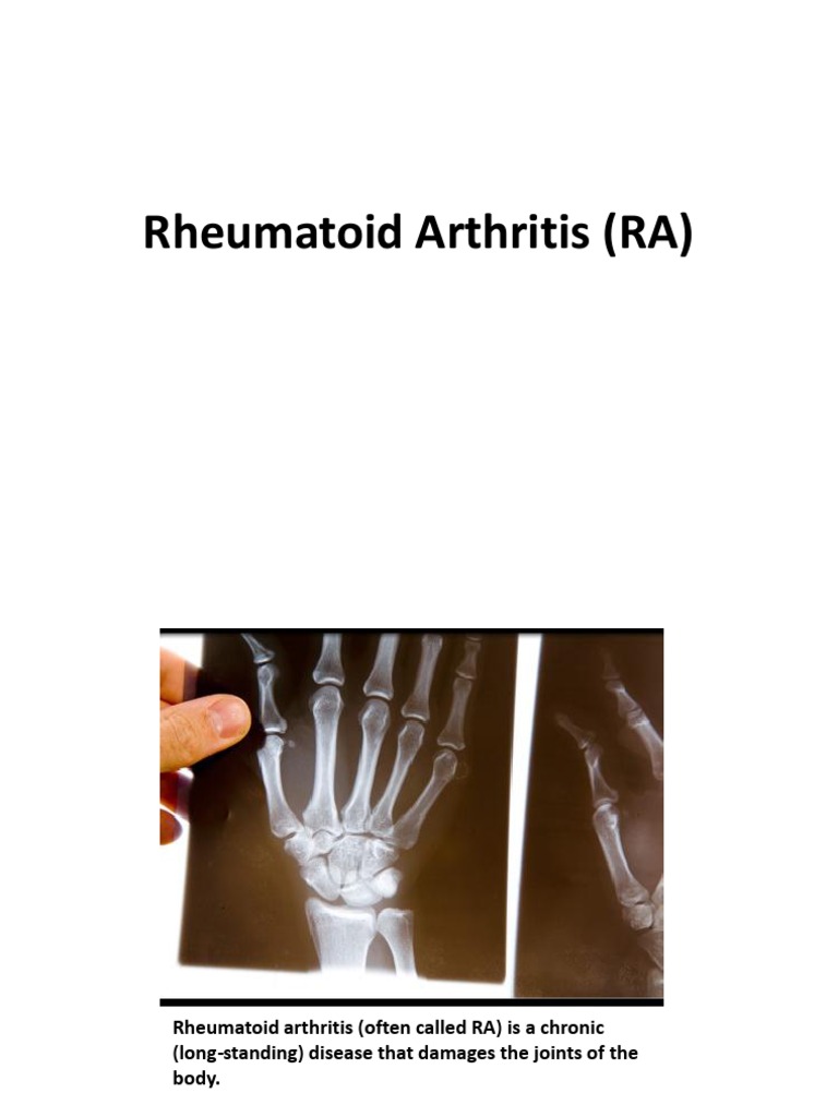 Rheumatoid Arthritis (RA) PD.ppt | Arthritis | Rheumatoid Arthritis