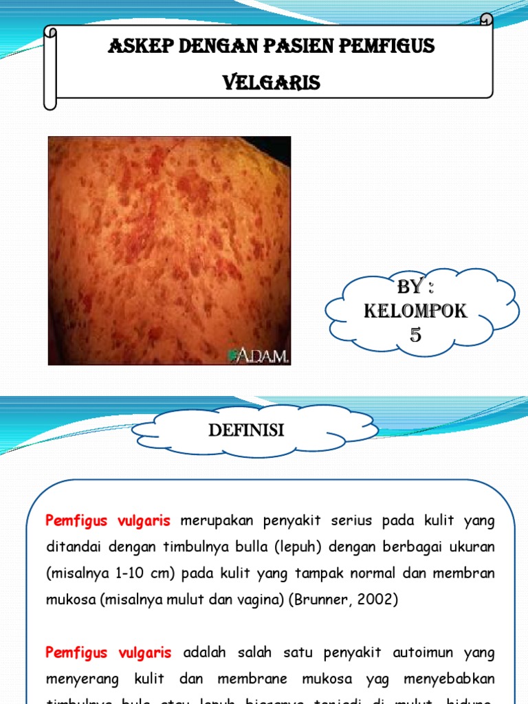 Pp. Pemfigus Vulgaris | PDF