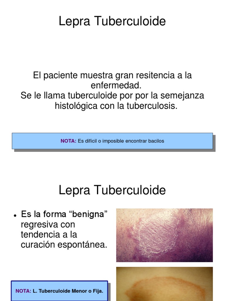 Lepra Tuberculoide | PDF | Lepra | Drogas