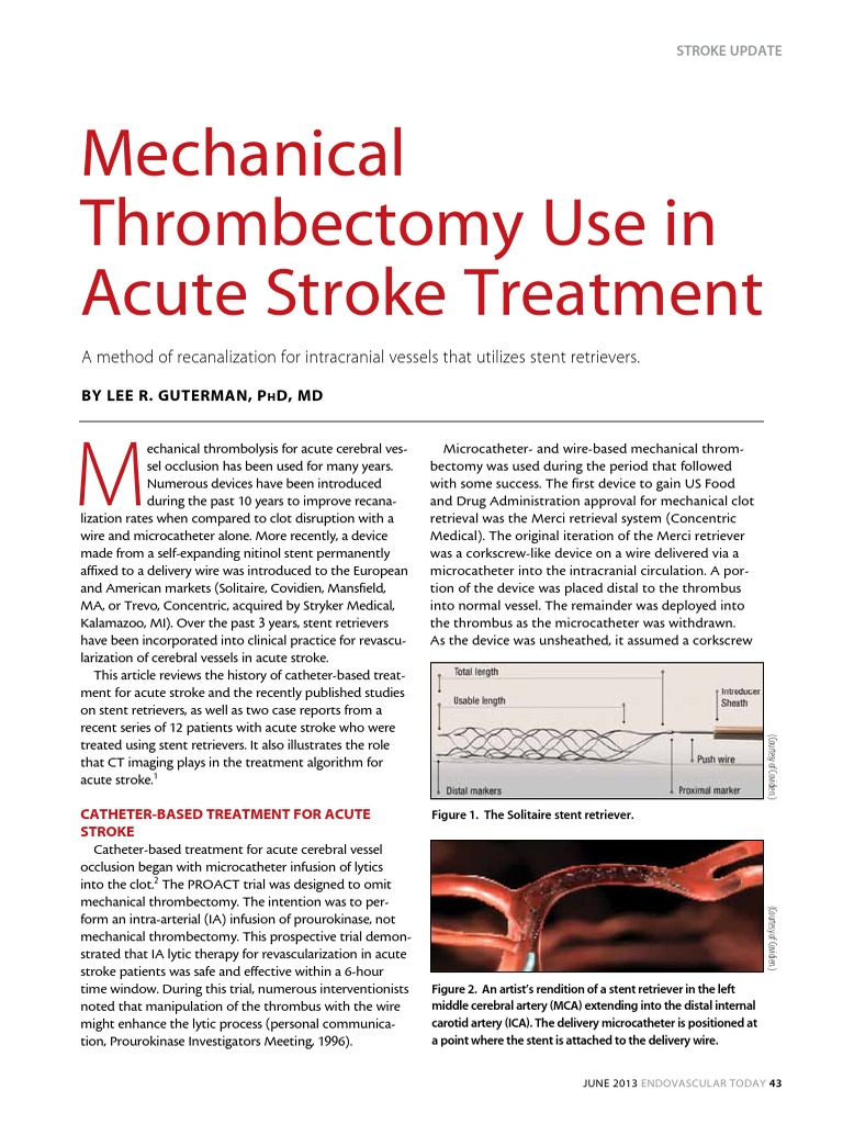 Thrombectomy in Acute Stroke | PDF | Stroke | Angiology