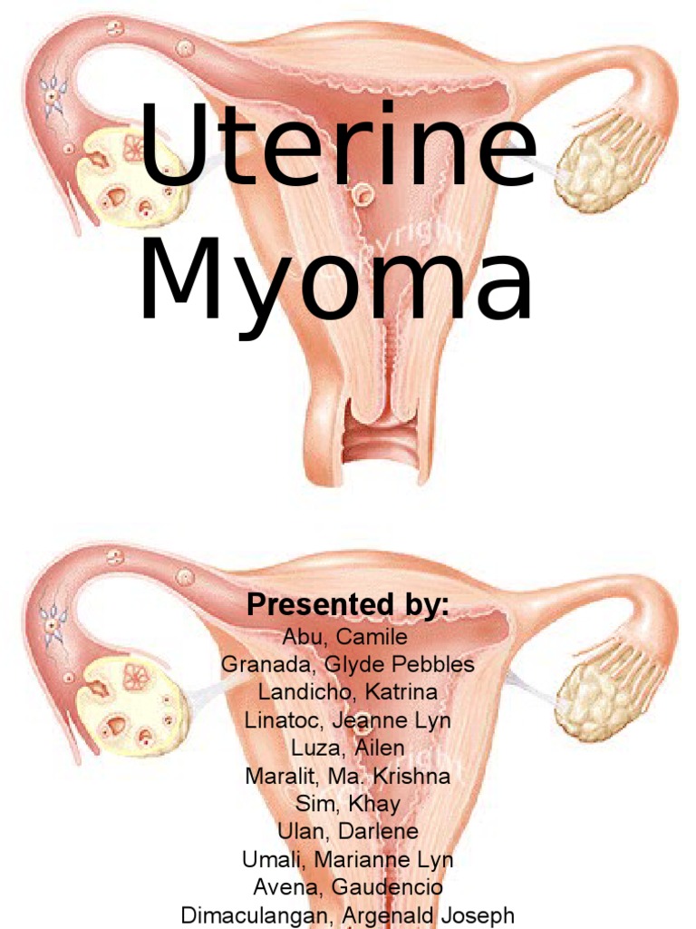Myoma Case Uterus Estrogen