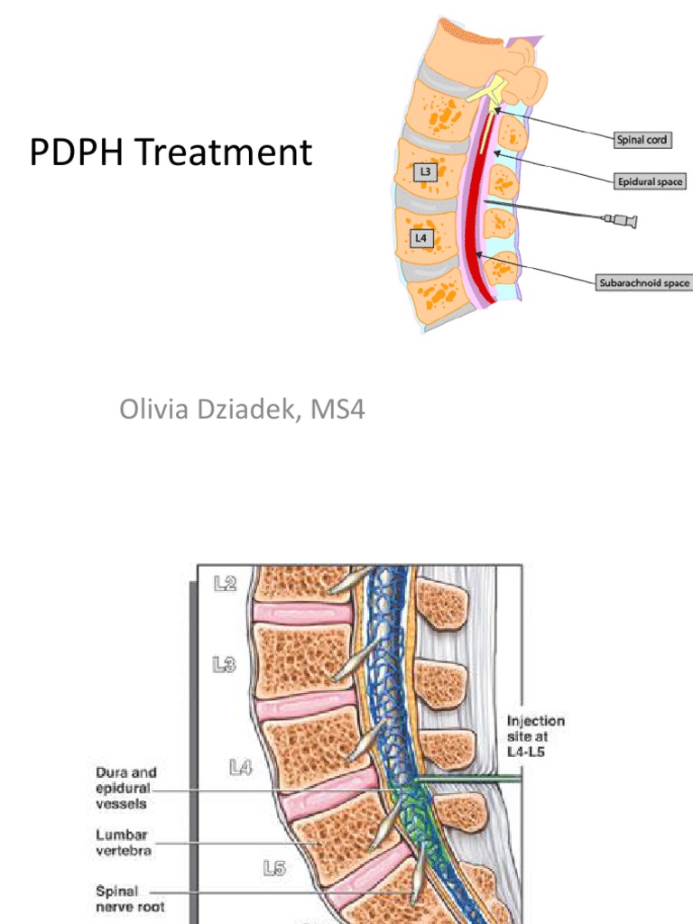 PDPH | Headache | Medicine