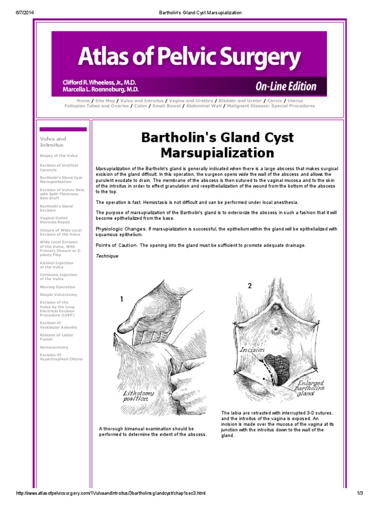 Bartholins Gland Cyst Marsupialization Vagina Surgery