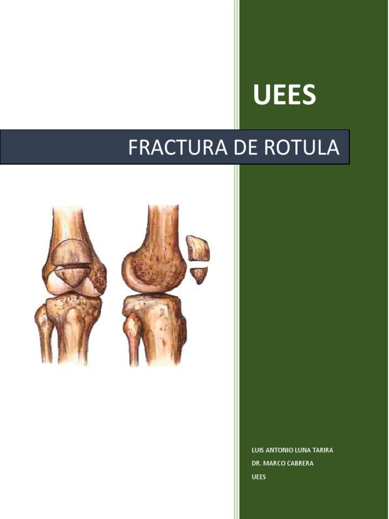 Manejo de Fracturas de Rótula | PDF | Ciencias de la Salud ...