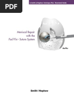 FiberStitch™ Meniscal Repair Technique | PDF | Surgical Suture ...