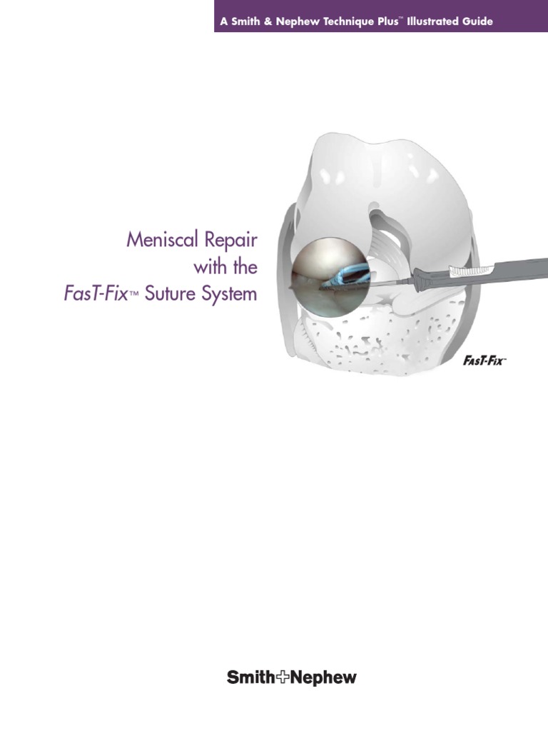 Meniscal Repair With The Suture System: Fast-Fix | PDF | Surgical ...