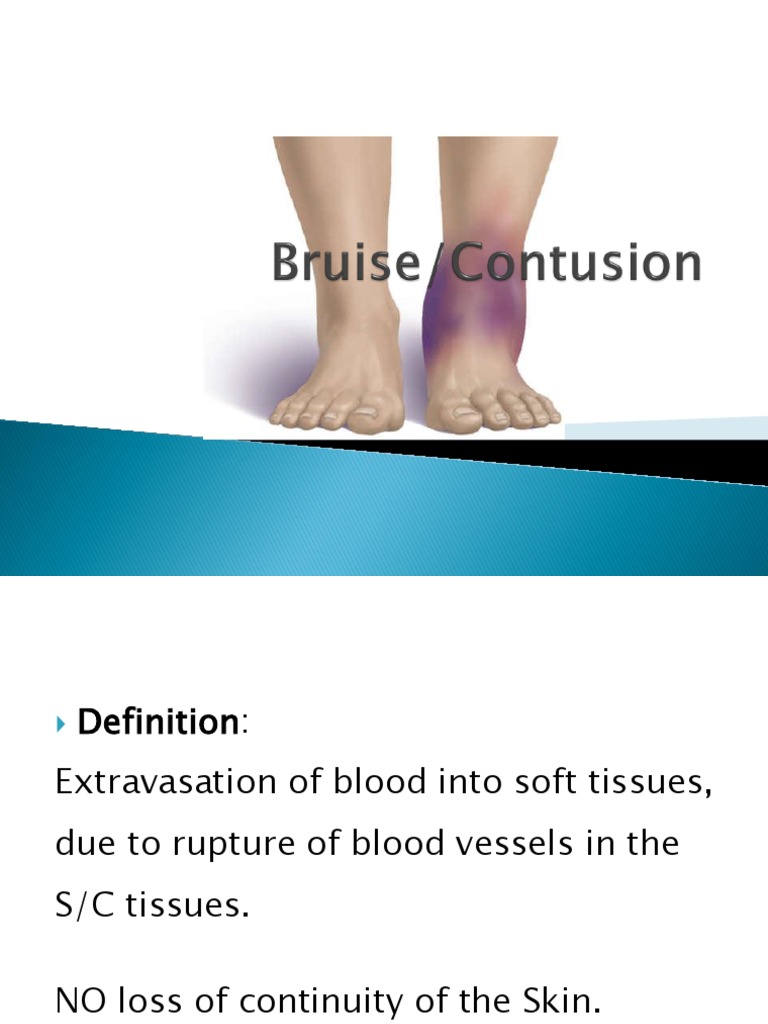 Bruise | Anatomy | Tissue (Biology)
