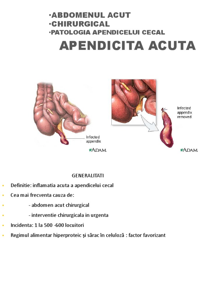 Apendicita Acuta