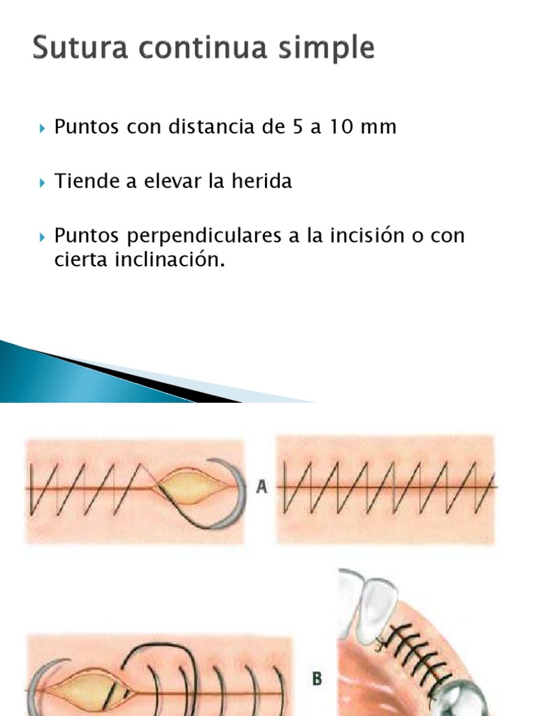 Tipos de sutura continua y técnica | PDF