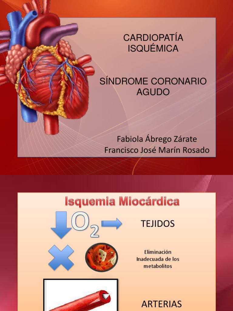 Cardiopatía Isquémica | PDF | Infarto de miocardio | Angina de pecho