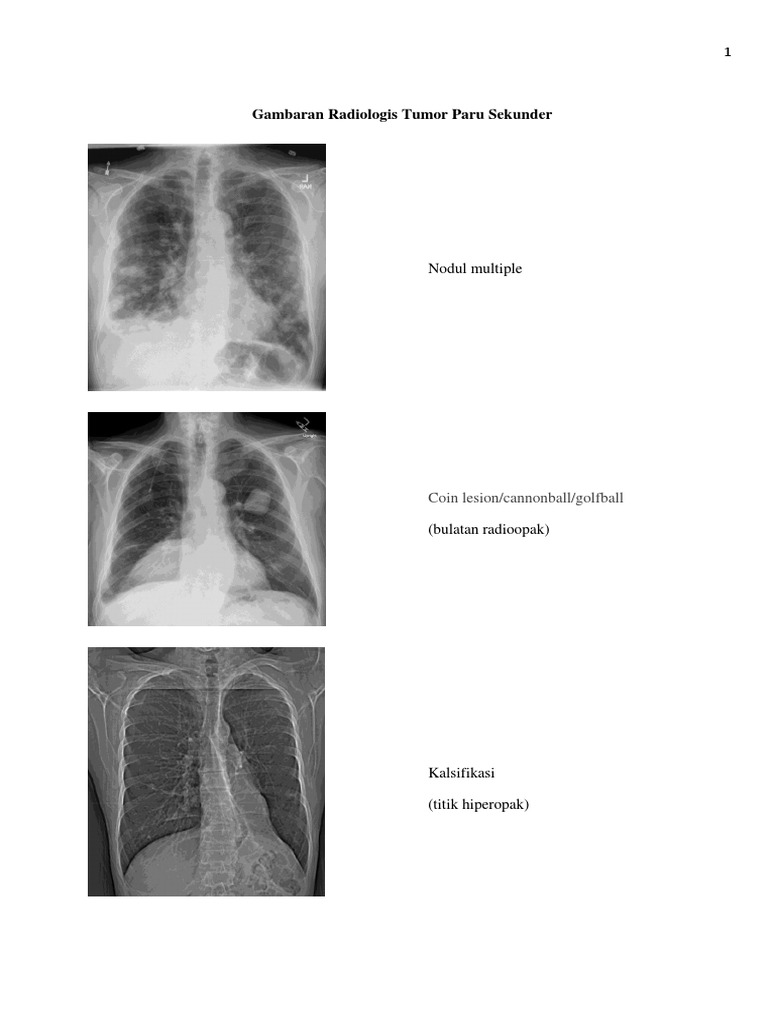 Gambaran Radiologis Tumor Paru Sekunder | PDF