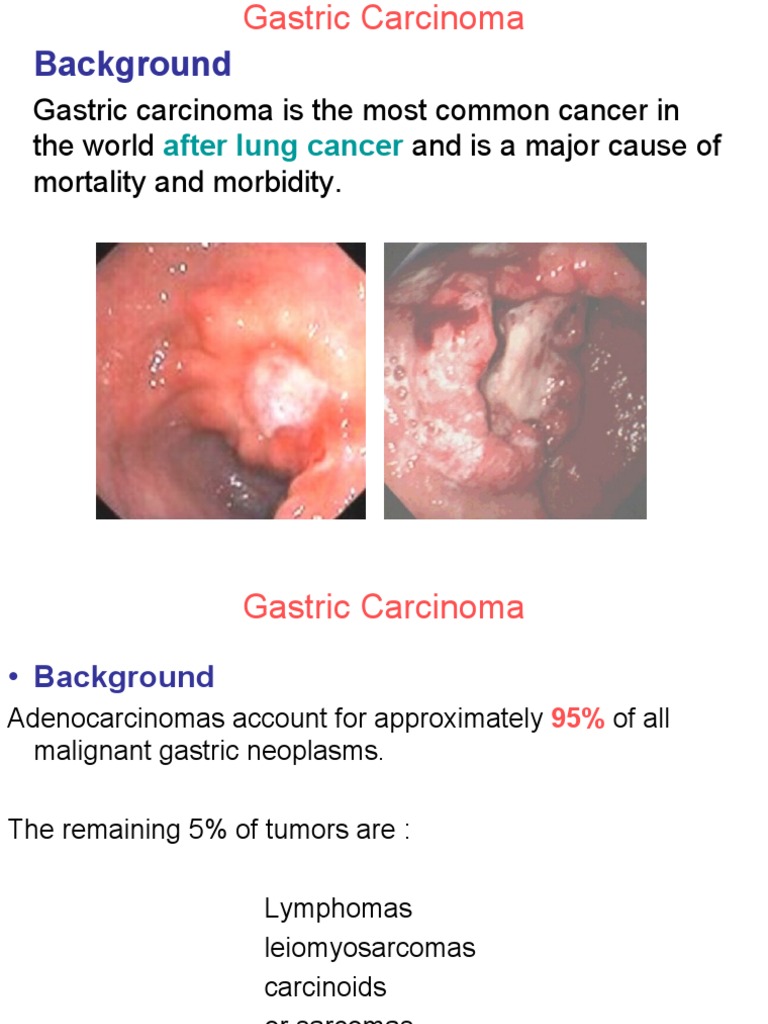 Gastric Carcinoma | PDF | Stomach | Carcinoma