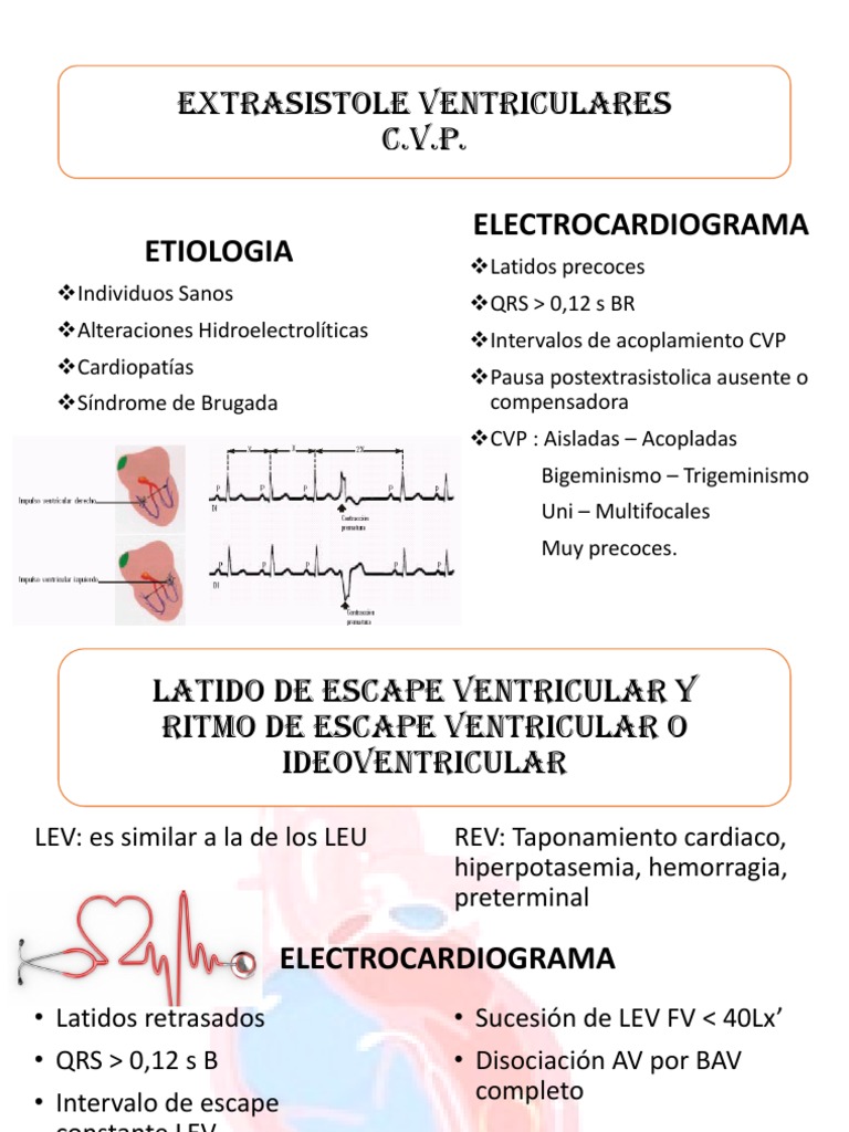 Extrasistole Ventriculares | PDF | Arritmia cardiaca | Electrocardiografia