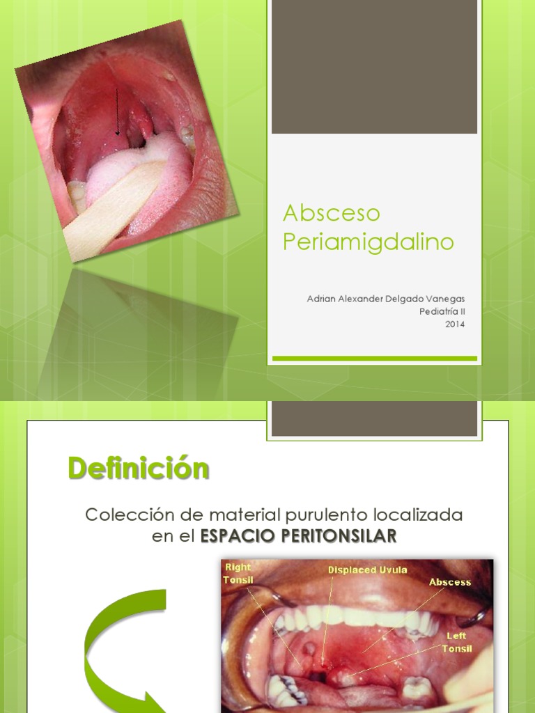 Absceso Periamigdalino | PDF
