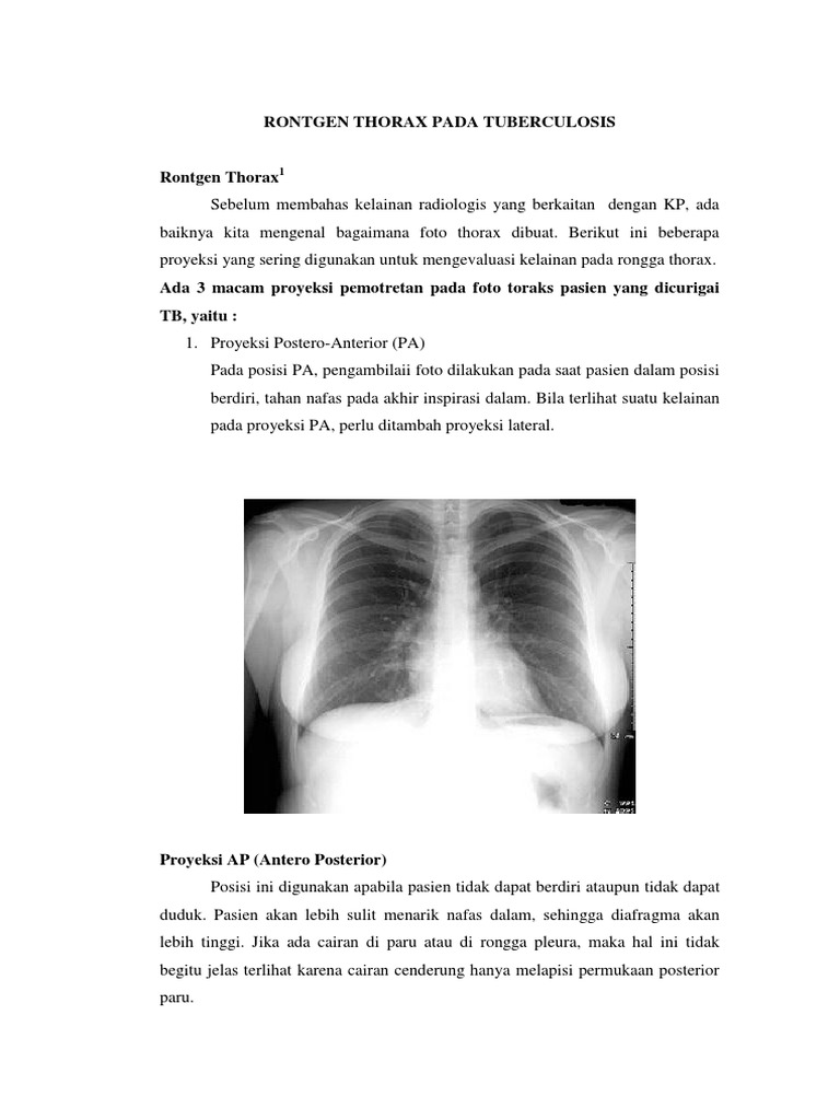 Rontgen Thorax Pada Tuberculosis | PDF