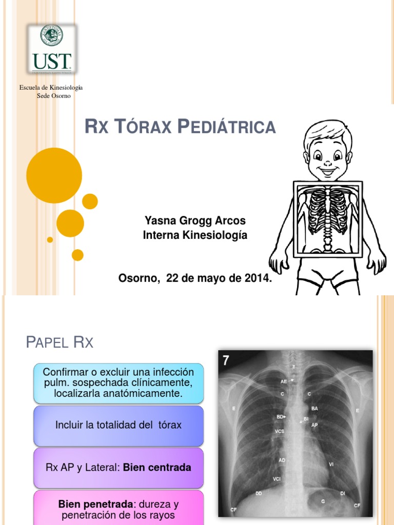 RX Tórax Pediátrica | PDF