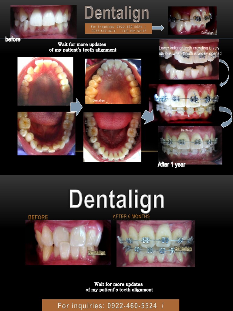 Lower Anterior Teeth Crowding Issues | PDF