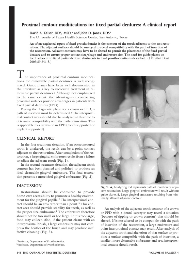 Design of FPD | PDF | Dentures | Dental Implant