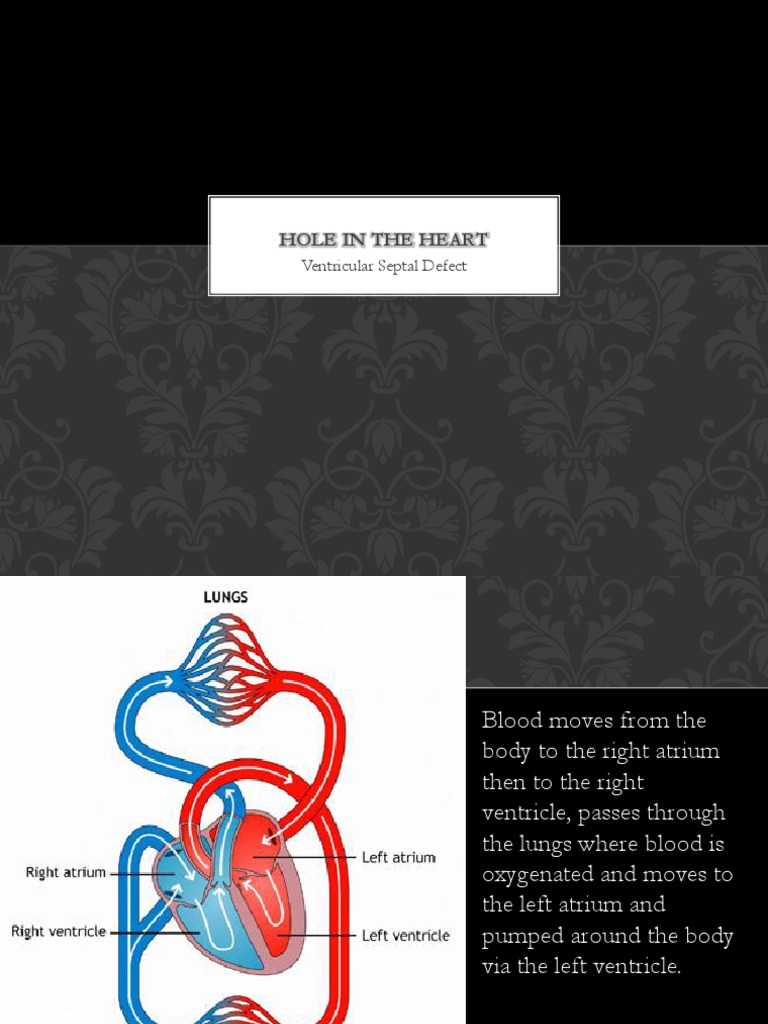 Ventricular Septal Defect Presentation | PDF | Ventricle (Heart ...