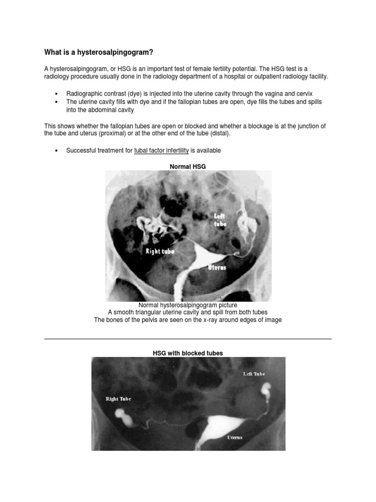 What is an HSG? Test Shows Fallopian Tube Blockages | PDF | Uterus ...