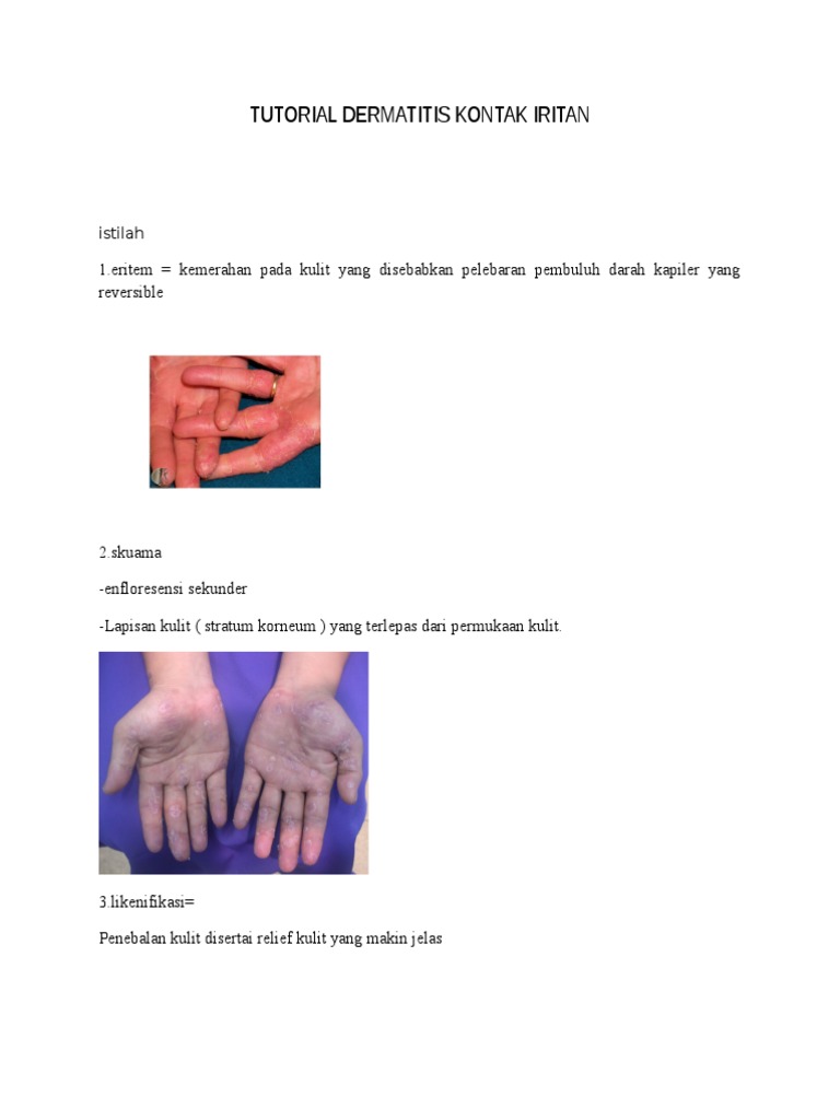 Dermatitis Kontak Iritan | PDF