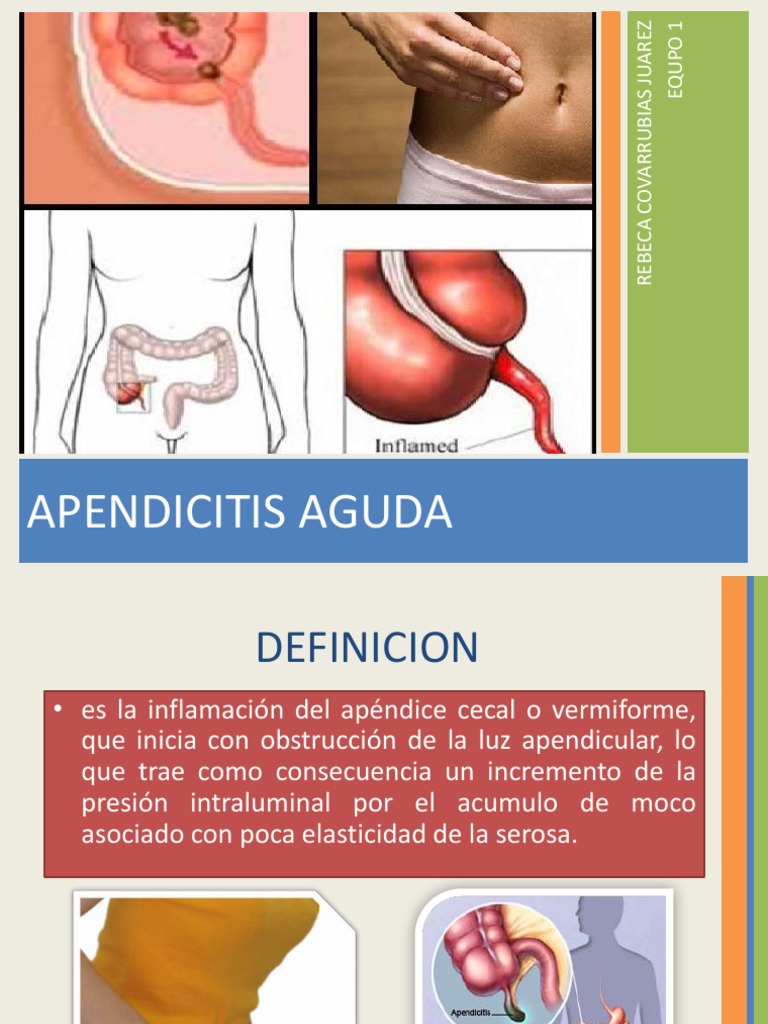 Apendicitis aguda | Medicina CLINICA | Especialidades Medicas