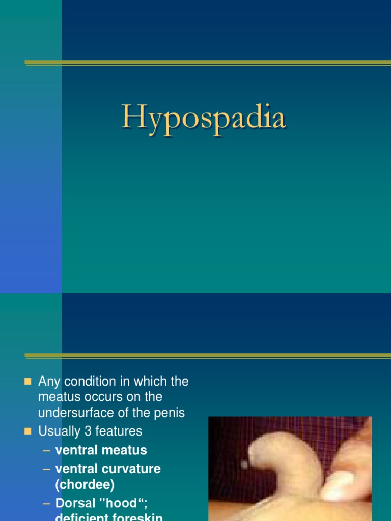 Hypospadias SDC | PDF | Sexual Anatomy | Medical Specialties