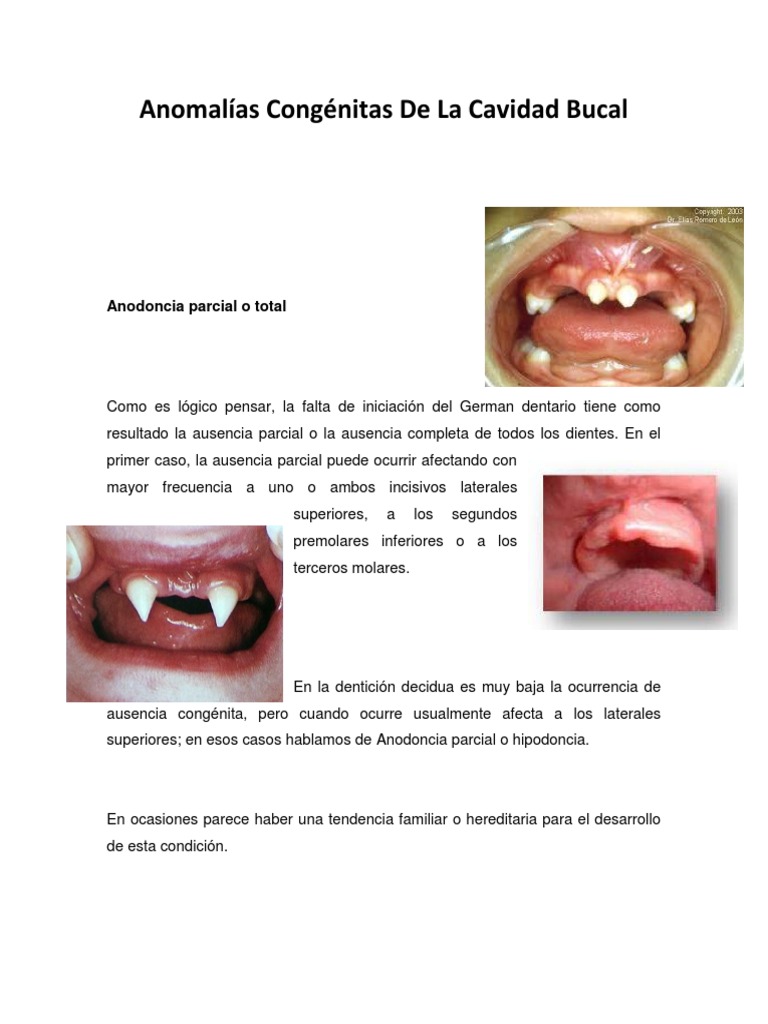 Anodoncia y anomalías dentales congénitas | PDF | Diente humano ...