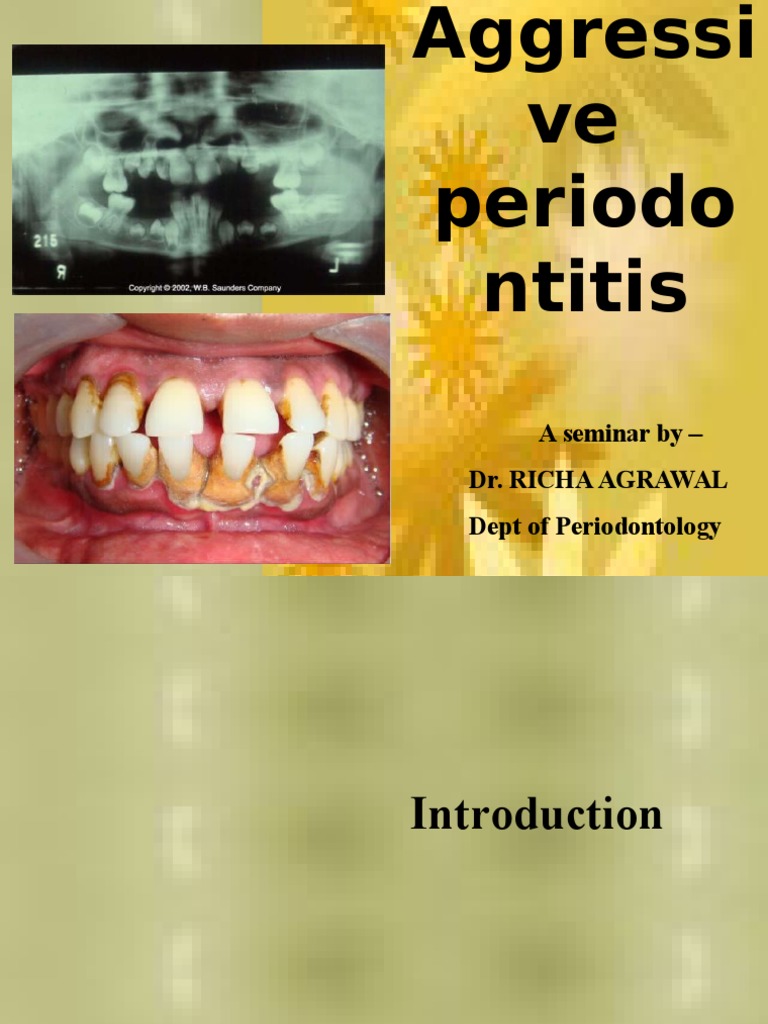 Aggressive Periodontitis | Human Tooth | Immune System