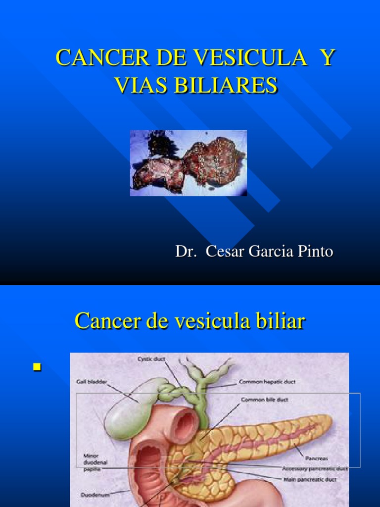 Cancer de Vesicula y Vias Biliares | Vesícula biliar | Hígado