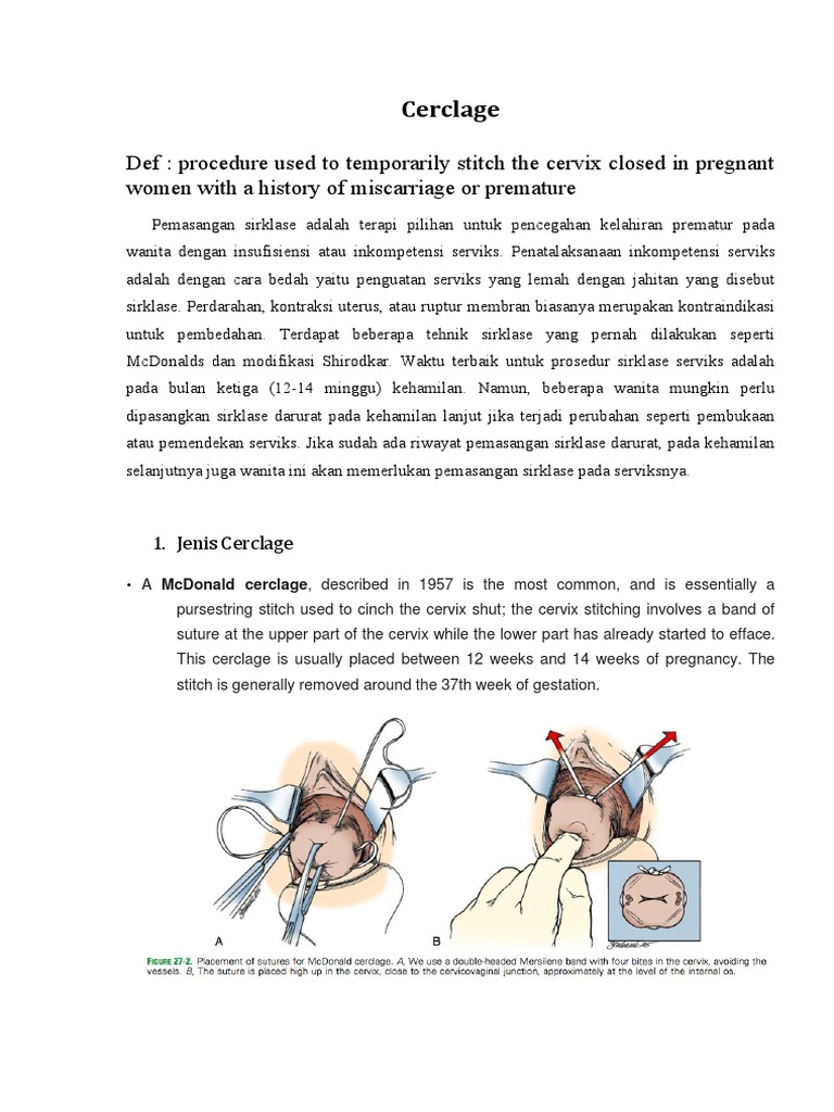Cerclage | PDF | Childbirth | Preterm Birth