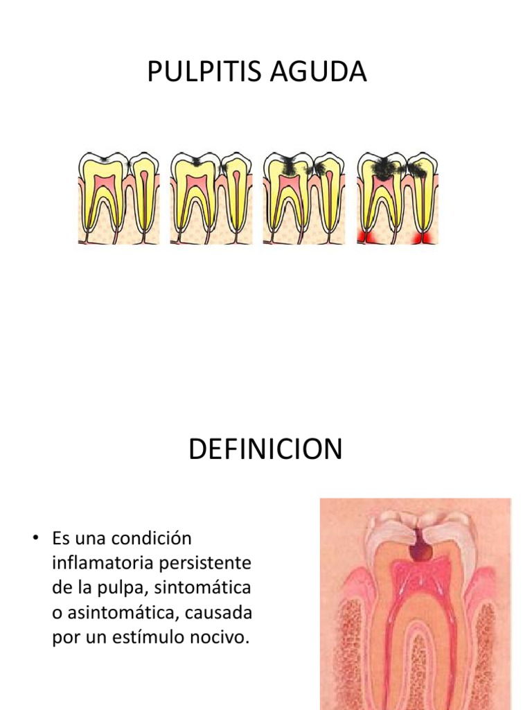 Pulpitis Aguda | PDF