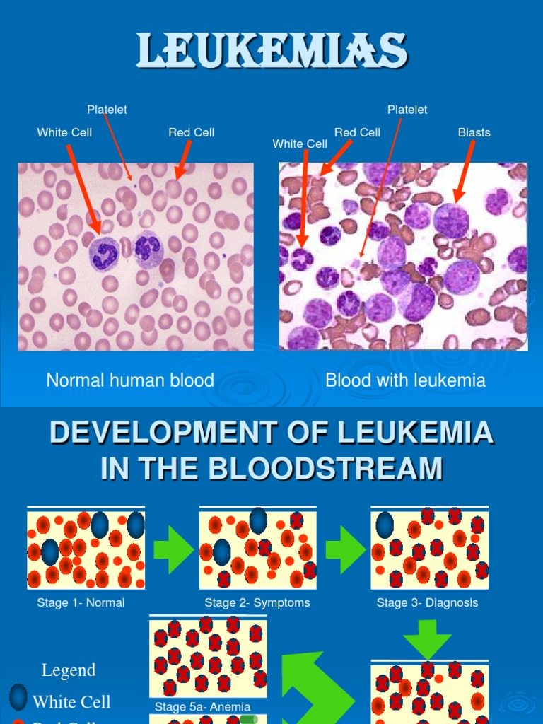 Leukemias Ppt | Leukemia | White Blood Cell